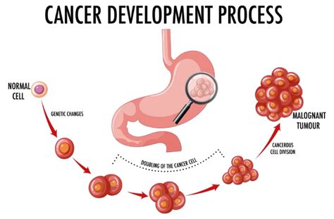 Stage 4 Stomach Cancer Treatment and Survival An Tâm