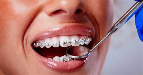 C Mo Se Ponen Los Brackets T Cnicas Tiempo Y Precios