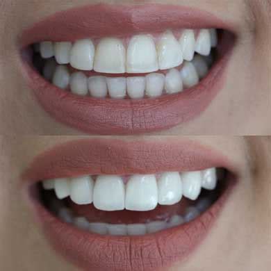 The Ultimate Guide To Composite Veneers For Crooked Teeth In Sydney