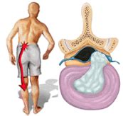 Quiropraxia para todos Hernia Discal una Patología de tratamiento