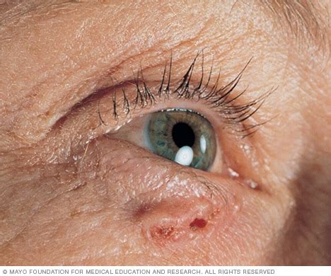 Carcinoma de células basales Síntomas y causas Mayo Clinic