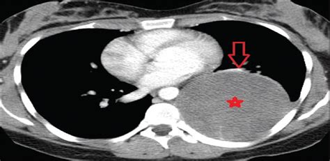 A Rare Case Of Primary Benign Schwannoma Of The Pleura Digital Medicine