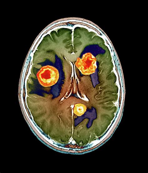 Secondary Brain Cancer Photograph By Zephyr Science Photo Library Pixels