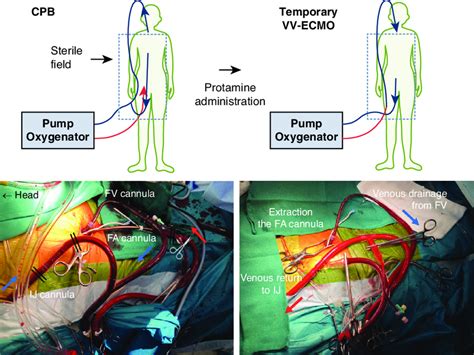 Overview Of The Cardiopulmonary Bypass CPB And Venovenous