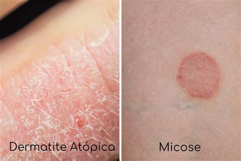 Dermatite Atópica O que é sintomas causas e tratamento CliniGuia