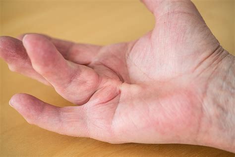 Trigger Finger Dupuytren S Contracture Banner Health 44 OFF