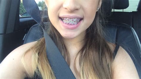 Caitlyn Getting Her Full Braces On Kaz Miller Flickr