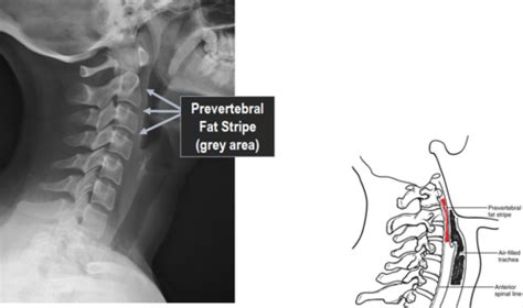 IMAGE ANALYSIS CHAPTER 8 C Spine And T Spine Flashcards Quizlet