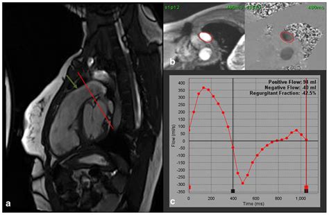 A Steady State Free Precession SSFP Right Ventricular Outflow Tract