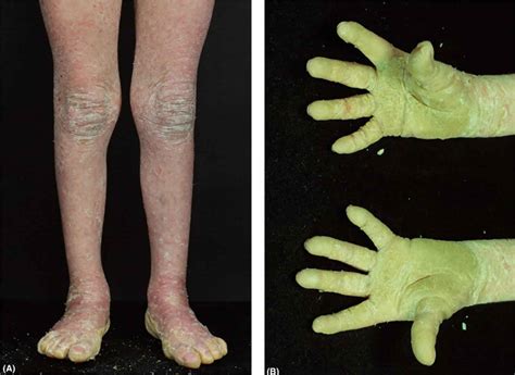 Epidermolytic Hyperkeratosis Causes Symptoms Diagnosis Treatment