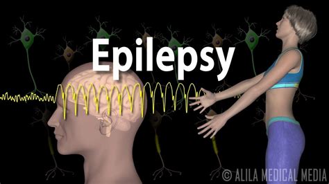 Epilepsy Types Of Seizures Symptoms Pathophysiology Causes And