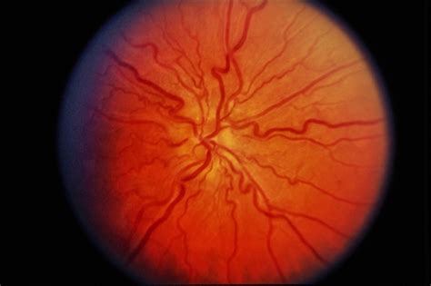 Congenital Tortuous Vessels Coloboma Retina Image Bank