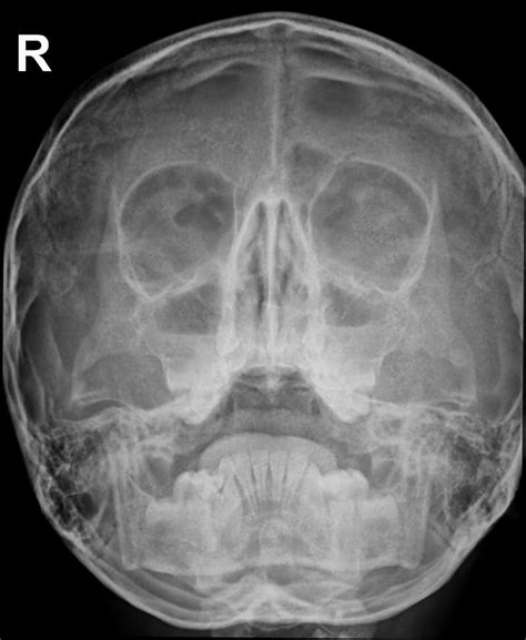 Sinus X Ray Tacitceiyrs