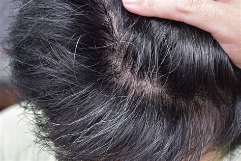 Understanding The Different Types Of Scalp Conditions