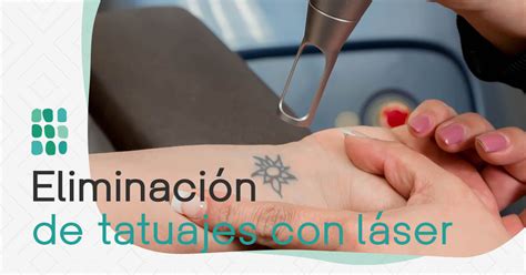 Eliminación de Tatuajes con Láser en Tijuana