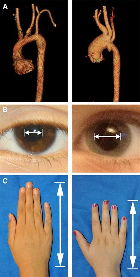 Hereditary Influence In Thoracic Aortic Aneurysm And Dissection