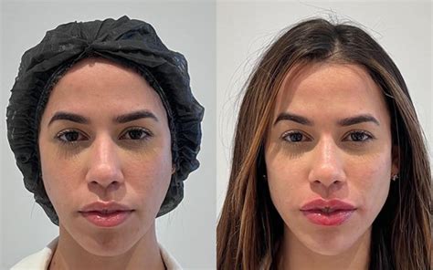 Ex Bbb Larissa Tom Sia Mostra Antes E Depois De Harmoniza O Facial