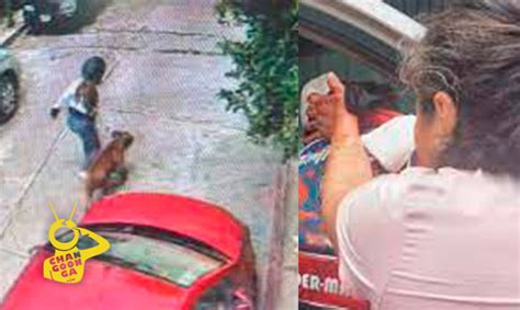 Se Le Fue Directo A La Cara Perro Pitbull Ataca A Niño De 5 Años En