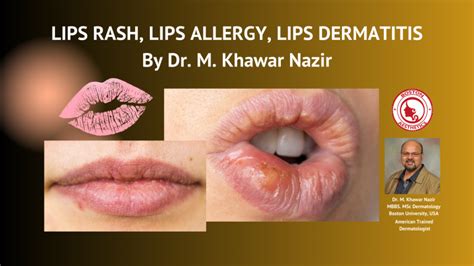 Understanding Lips Allergy Lips Rash And Lips Dermatitis Boston Aesthetics