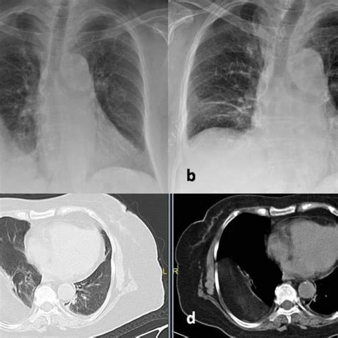 A B C And D Preoperative Chest X Ray A Postoperative Chest X Ray
