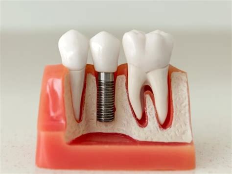 Cuál es la edad mínima para colocar un implante dental Dentista en