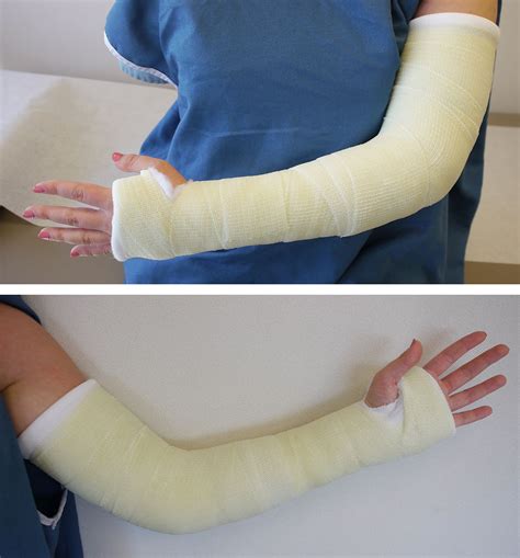 Types Of Plaster Cast Ppt Design Talk