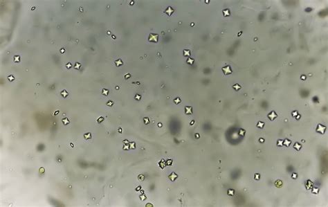 3 Hundred Calcium Oxalate Kidney Stones Royalty Free Images Stock
