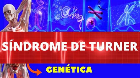 SÍNDROME DE TURNER O QUE É CAUSAS CARACTERÍSTICAS DIAGNOSTICO E