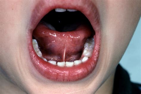 Anquiloglosia en bebés Cartagena Clínica Materno Infantil Matrioska
