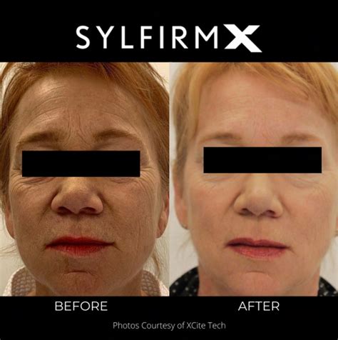 Radio Frequency Microneedling Dermatology SA