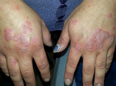 Psoriazis Simptome Cauze Si Tratamente Dr Mihai Lupu