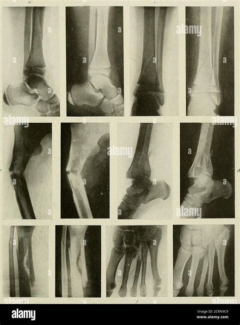 Radiografía y radioterapéutica Fig 225 fractura de os caleis