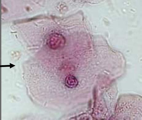 Urinalysis Part Urine Sediment Clin Path Flashcards Quizlet