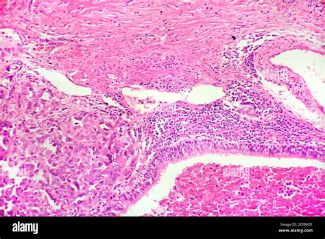 Lung Cancer Cells Hi Res Stock Photography And Images Alamy