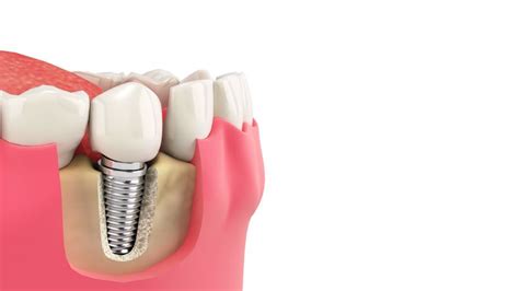 Cuáles son los síntomas del rechazo de un implante dental ZM Centro