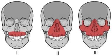 Initial Evaluation And Management Of Maxillofacial Injuries Overview