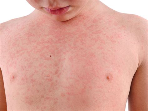 What Causes Pinprick Red Dots On Skin Not Itchy And How To Treat Them