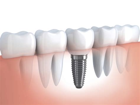 Quais são os tipos de implante dentário Técnicas