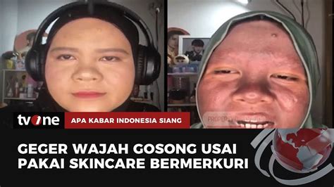 Cerita Nur Sha Wajah Gosong Terdampak Krim Merkuri AKIS TvOne