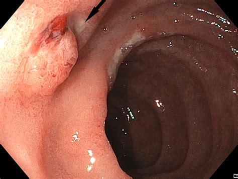 Acute Pancreatitis Due To Clipping Of The Ampulla With Over The Scope