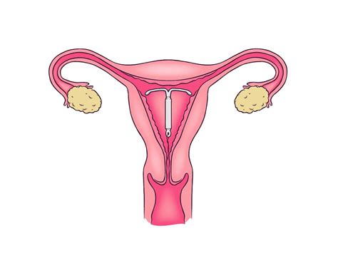 Cómo se coloca el dispositivo intrauterino DIU I Planned Parenthood