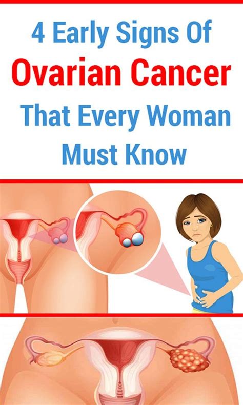 4 Early Signs Of Ovarian Cancer That Every Woman Must Know Custom Healthy