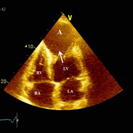 Two Dimensional Transthoracic Echocardiogram Apical Four Chamber View