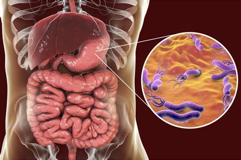 Treating Helicobacter Pylori Infection Reduces Gastric Cancer Risk