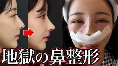 鼻整形壮絶な手術の様子を公開全てはキレイになるために YouTube
