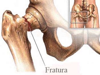 Fratura Do Colo Do F Mur Instituto Dr Clinic
