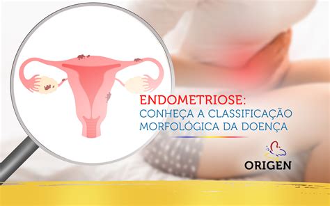 Endometriose Conhe A A Classifica O Morfol Gica Da Doen A Cl Nica
