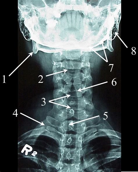 Ap Cervical Spine Anatomy Diagram Quizlet