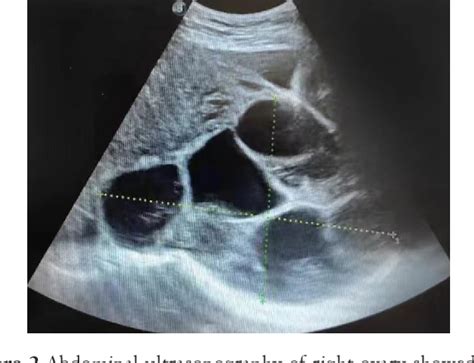 Figure 2 From A Case Report Of Spontaneous Ovarian Hyperstimulation