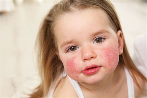 Alergia pokarmowa u dzieci Jakie objawy mogą ją sugerować Zdrowie